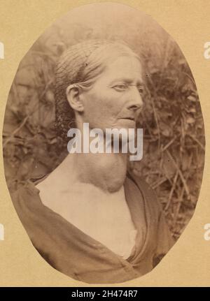 Femme avec un kyste ou un adénome kystique affectant le lobe droit de ...