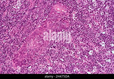 Glande parotide : kyste lymphoépithélial avec VIH Photo Stock - Alamy