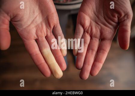 Main de la personne atteinte du phénomène de Raynaud lors d'une attaque ...