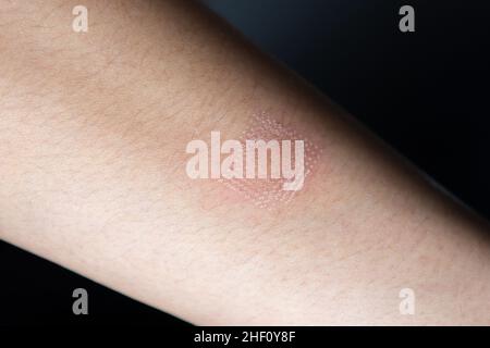 Marques après l'épilation au laser ou l'eczéma atopique cicatriciel ...