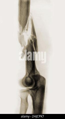 Radiographie d'un fémur fracturé (os de la cuisse) qui a été fixé à l ...
