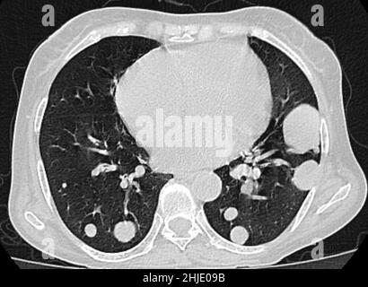 Tomodensitométrie axiale du thorax (fenêtre pulmonaire) Chez un patient ...