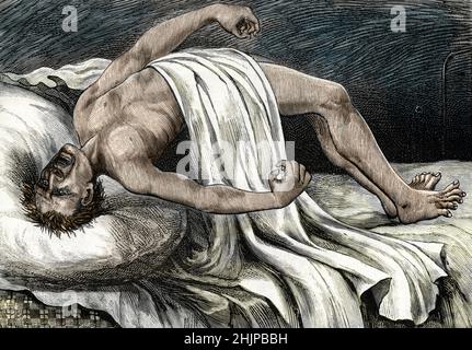 Opisthotonus chez un patient souffrant de tétanos - Tableau par Sir ...