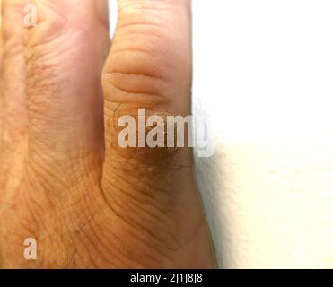 Verrue commune Verruca vulgaris sur la peau d'un enfant, papillomavirus ...