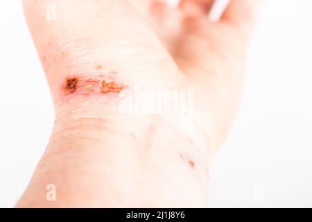 brûlure chimique sur la peau du poignet avec de l'hydroxyde de sodium ...