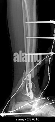 Radiographie d'une fracture de la jambe et une fixation externe Photo ...