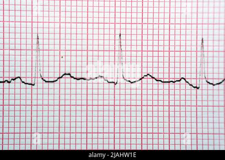 Papier d'électrocardiographe ECG présentant un NSR de rythme sinusal ...