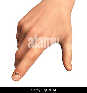 Onychomycose ou mycose des ongles infection ou tinea unguium comme un ...