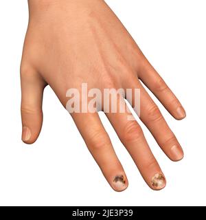 Onychomycose ou mycose des ongles infection ou tinea unguium comme un ...