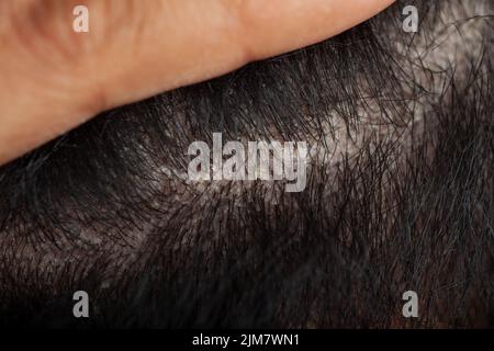 Dermatite séborrhéique ou infection fongique de la peau au cuir chevelu ...