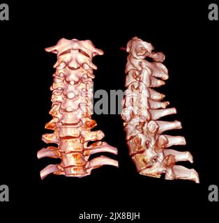 Les droits de l'épine cervicale et du crâne. 3D computed tomography (CT ...