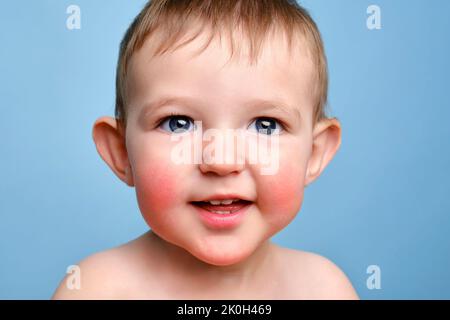 Bébé tout-petit heureux avec des allergies sur son visage, fond de ...
