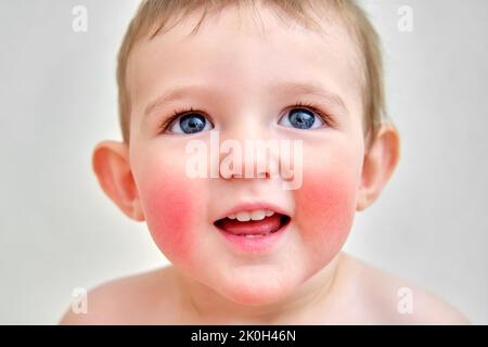 Bébé tout-petit heureux avec des allergies sur son visage, fond de ...
