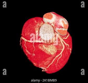 Artère coronaire TDM cardiaque 3D ou CTA montrant des branches ...