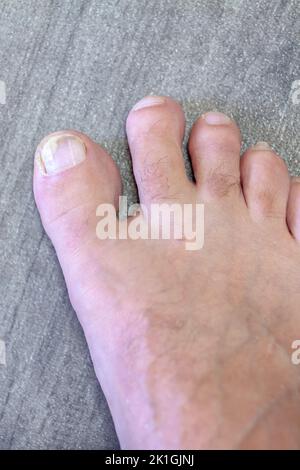 Maladie dermatologique affectant les ongles du pied causée par un ...