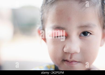 Stye maladies de l'œil. Fermé asiatique enfant petite fille oeil avec ...