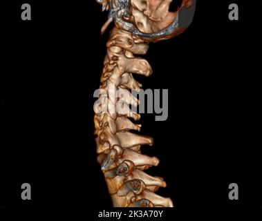Acquisition CT du rachis cervical ou du rachis cervical 3D rendu pour le diagnostic de fracture ...