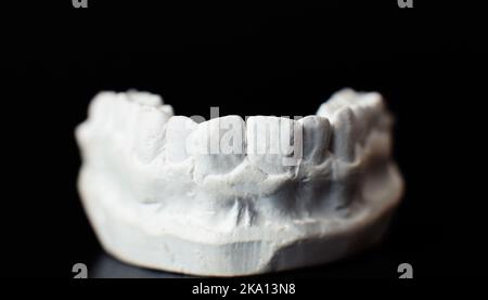 Modèle de mâchoire dentaire sur fond noir.aligneurs dentaires ...