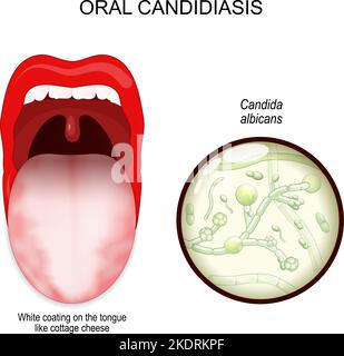 Candidoses buccales. Mycose buccale à candida albicans fongique sur les ...