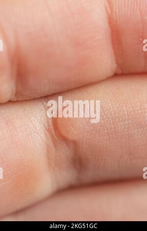 Verrue commune causée par le virus HPV Photo Stock - Alamy