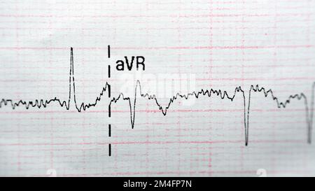 Papier d'électrocardiographe ECG présentant un NSR de rythme sinusal ...