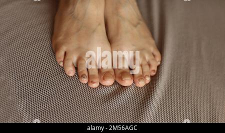 Pieds femelles avec hématome subungual, crapaules noires causées par un ...