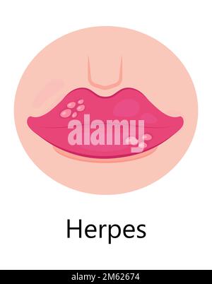 Virus de l'herpès simplex sur les lèvres. Flambée de fièvre. Maladie ...