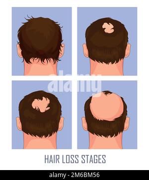 Perte de cheveux. Stades de l'alopécie homme problème vecteur santé ...