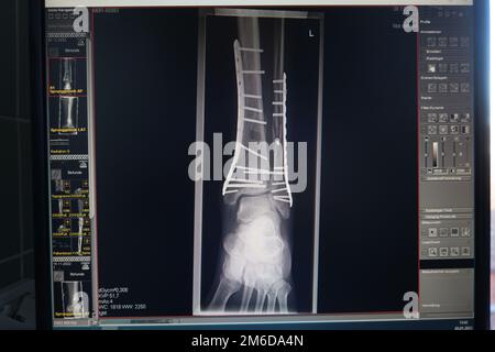 Une radiographie montre une fracture de l'articulation de la cheville ...