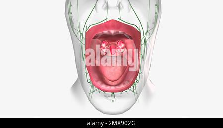 La gorge streptococcique est une affection courante causée par une ...