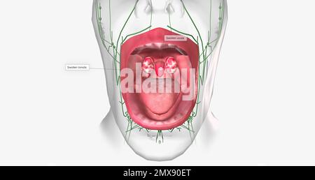 La gorge streptococcique est une affection courante causée par une ...