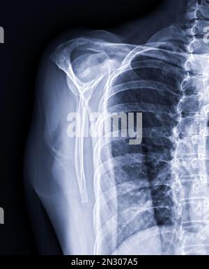 Vue transcapsulaire de l'articulation de l'épaule à rayons X pour le ...