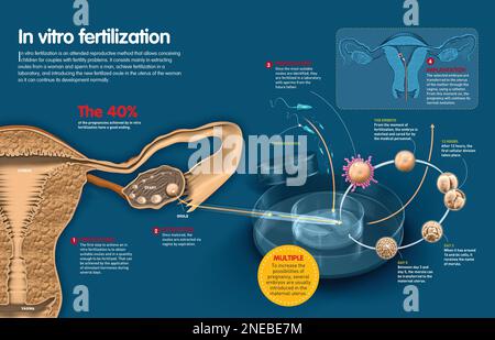 Infographie du processus de fécondation in vitro, de ce qu'il est et de ...