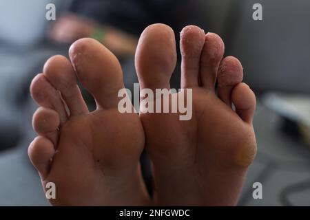 Éruption cutanée douloureuse, taches rouges cloques sur la main. Gros ...