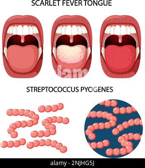 Fièvre de la scarlatine. Symptômes de la scarlatina. Bouche avec ...