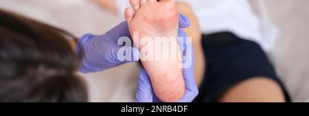 Le médecin examine les éruptions cutanées rouges sur les pieds de l ...