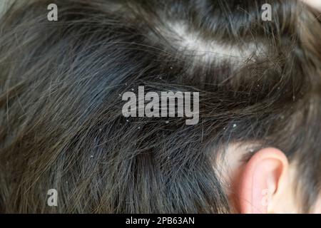 Pellicules dans les cheveux d'enfant. Cuir chevelu fragile. Pellicules ...