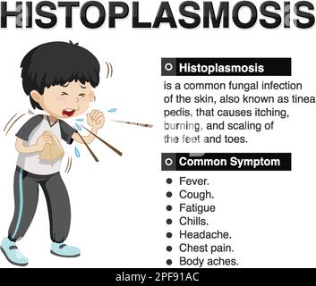 Affiche informative de l'illustration de l'histoplasmose Image Vectorielle Stock - Alamy