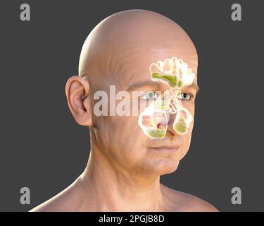 Infection sinusale, ou sinusite, illustration informatique. Les sinus ...
