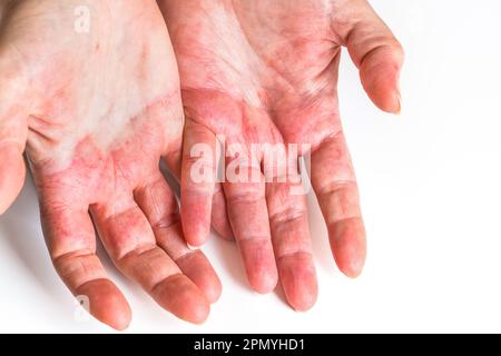 Les mains avec une dermatite allergique, problèmes dermatologiques. Le ...