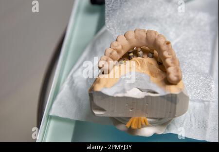 Modèle en plastique d'une prothèse dentaire permanente en céramique ...
