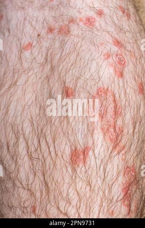 ULCÈRES DE JAMBE Photo Stock - Alamy