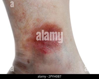 Gros plan sur la peau, une dermatite allergique Dermatite eczéma ...