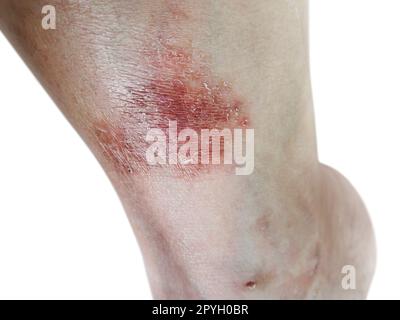 Réaction allergique, éruption de peau, fermer la vue portrait d'un ...