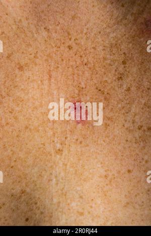 Le carcinome basocellulaire superficiel Photo Stock - Alamy