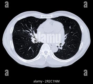 Scanner CT de poitrine ou de poumon pour le dépistage des nodules ...