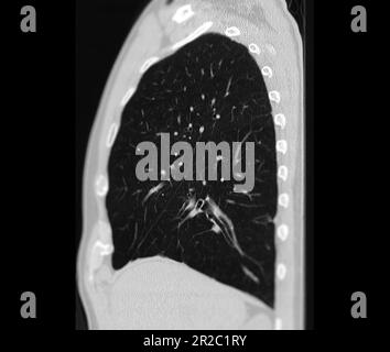 Scanner CT de poitrine ou de poumon pour le dépistage des nodules ...