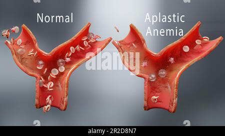 Anémie quantité de cellules sanguines ou d'hémoglobine et normale ...