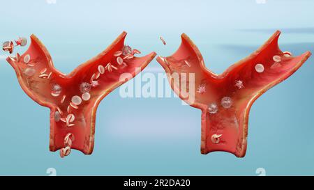 Anémie quantité de cellules sanguines ou d'hémoglobine et normale ...