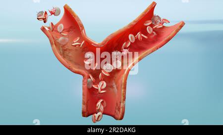 Anémie quantité de cellules sanguines ou d'hémoglobine et normale ...